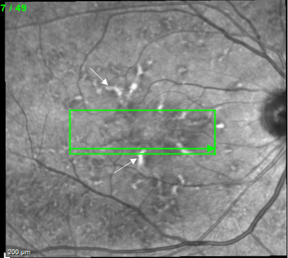 Maladie de Stargardt : Diagnostic et Suivi à Paris Rétina Vision