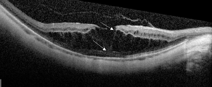 Traitement du Rétinoschisis du Myope à Paris | Centre Paris Retina Vision
