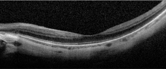 Traitement du Rétinoschisis du Myope à Paris | Centre Paris Retina Vision