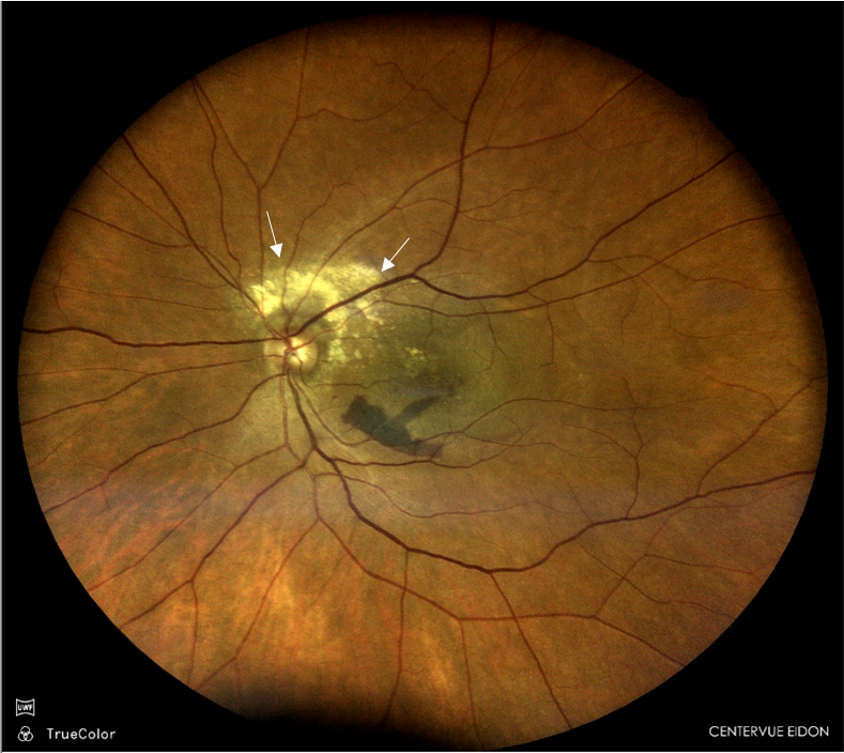 Traitement de la VPC (Vasculopathie Polypoïdale) - Paris Rétina Vision