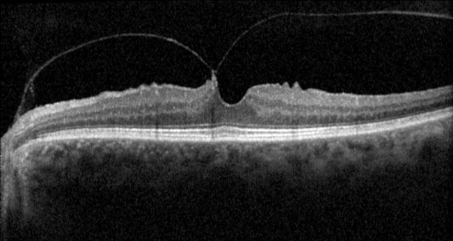 Traction Vitréo-Maculaire : Diagnostic et Traitement | Paris Retina Vision