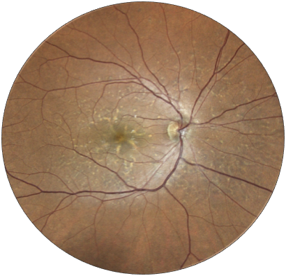 Maladie de Stargardt : Diagnostic et Suivi à Paris Rétina Vision